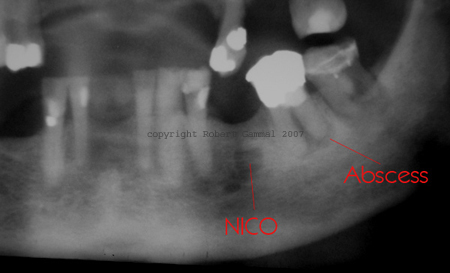 Cavitations - NICO Lesions - holes in the bone. - Real Dental Info